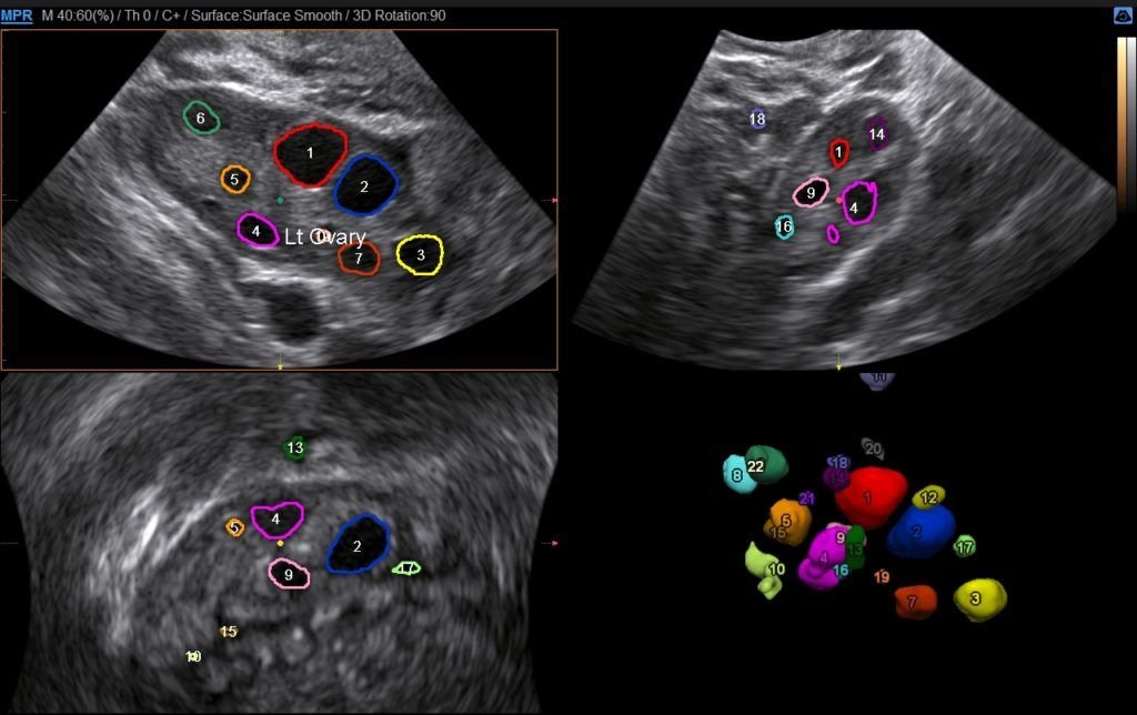 Follicular Studies - Krishna IVF Clinic