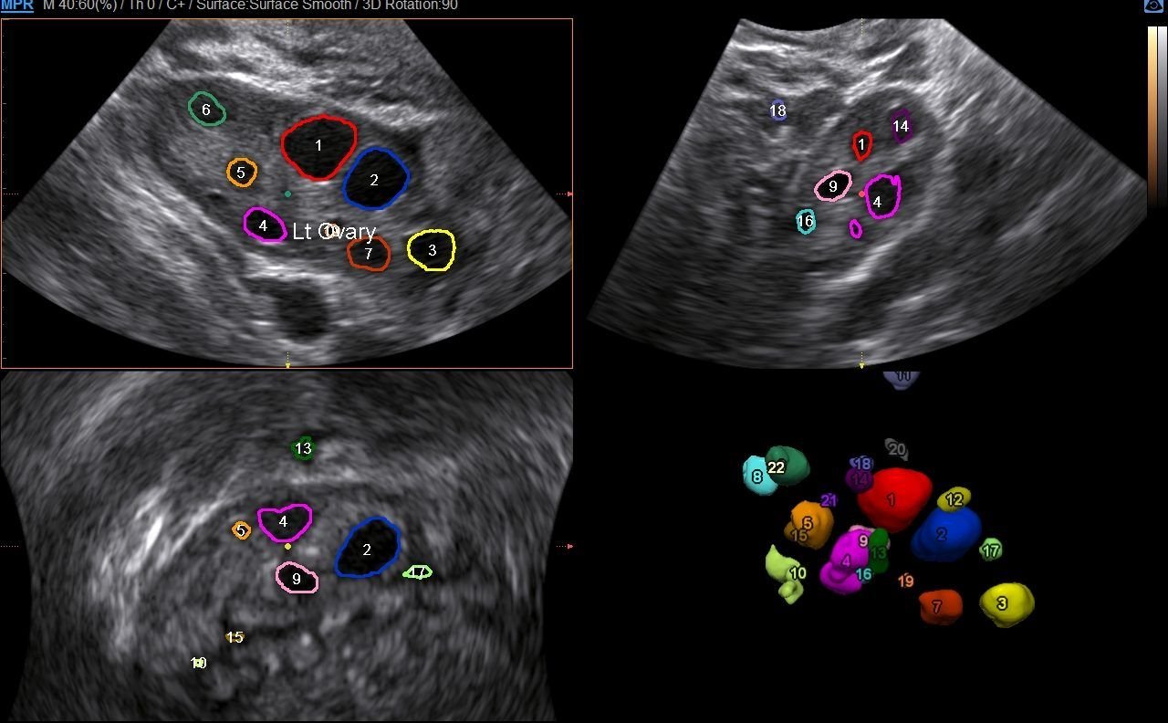 5D Follicle Imaging | Krishna IVF
