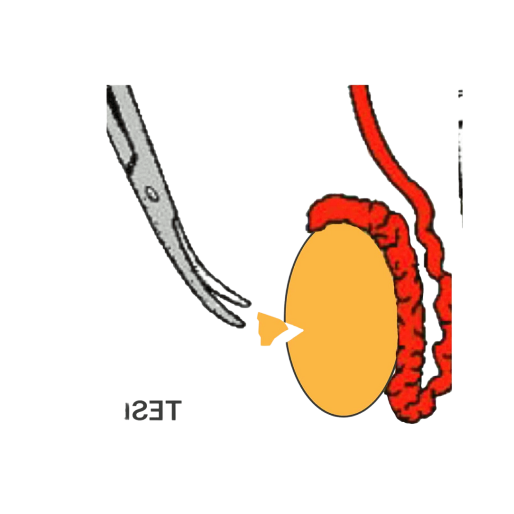 Vasectomy Reversal Vs IVF Choosing The Best Path To Parenthood